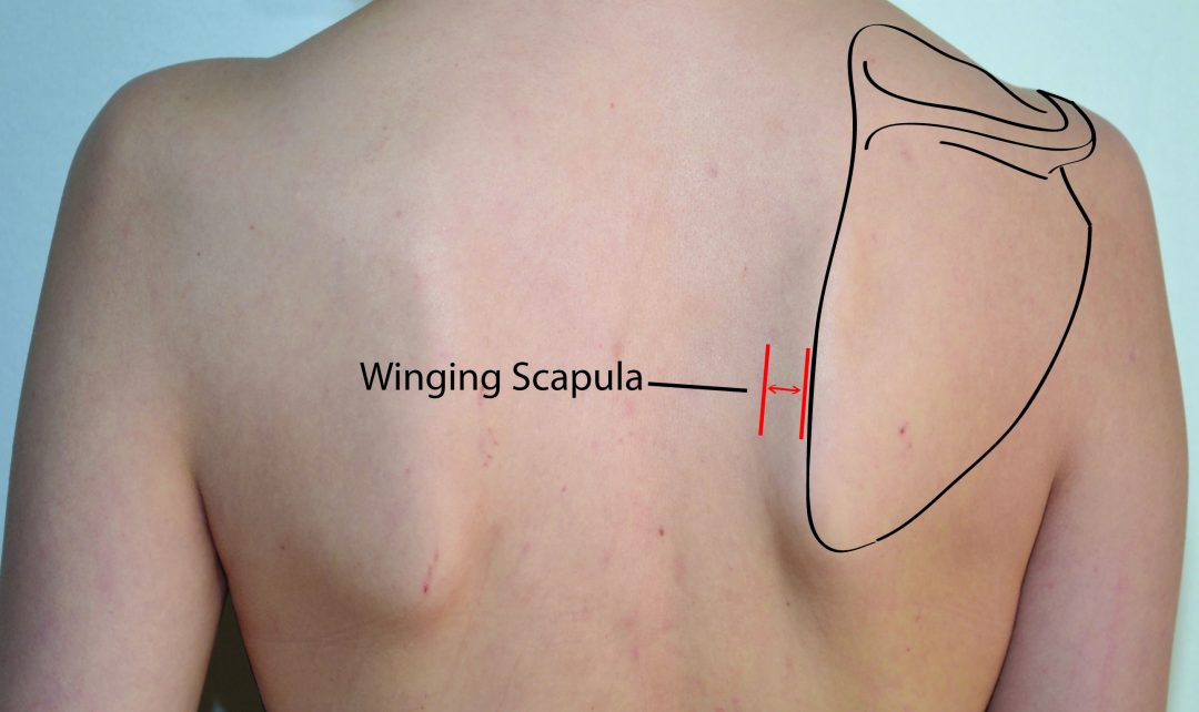 What is winged scapula and how to fix it | TFA (Training for Acro)